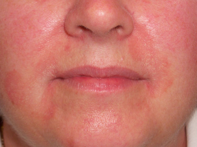 Dermatitis atópica - Cursos
